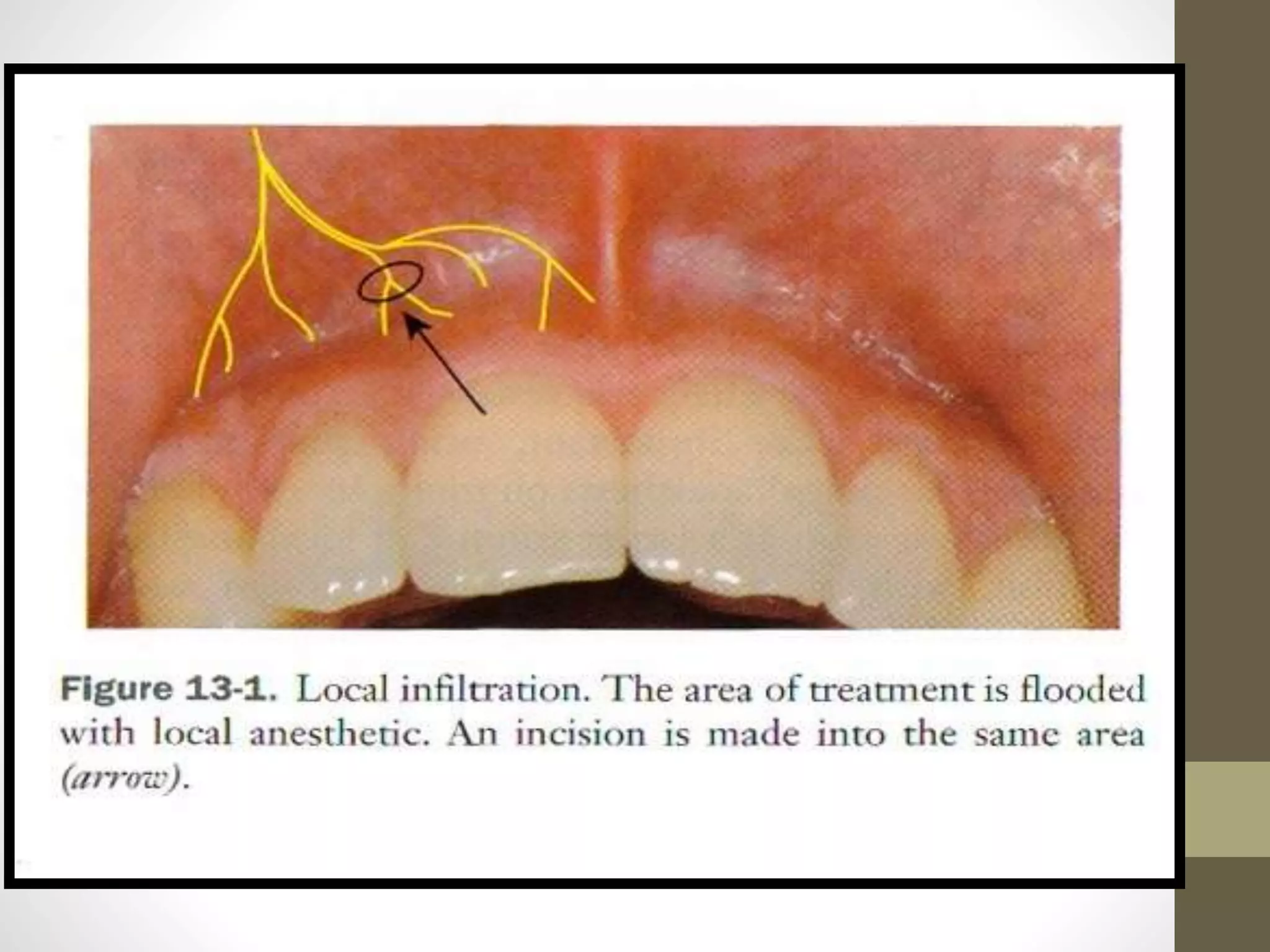 Maxillary anesthesia | PPT