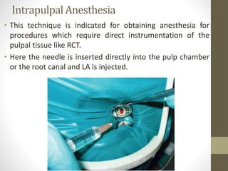 Maxillary anesthesia | PPT
