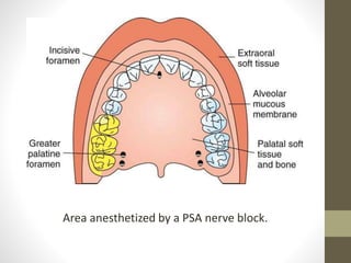 Nasopalatine Nerve Incisive Foramen