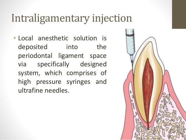 Maxillary anesthesia