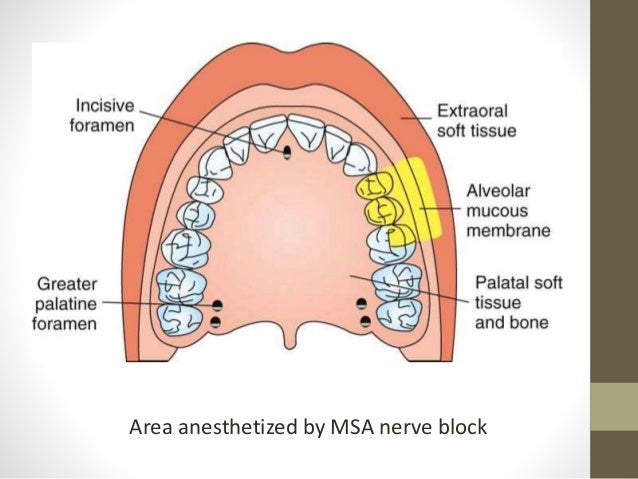 Maxillary anesthesia