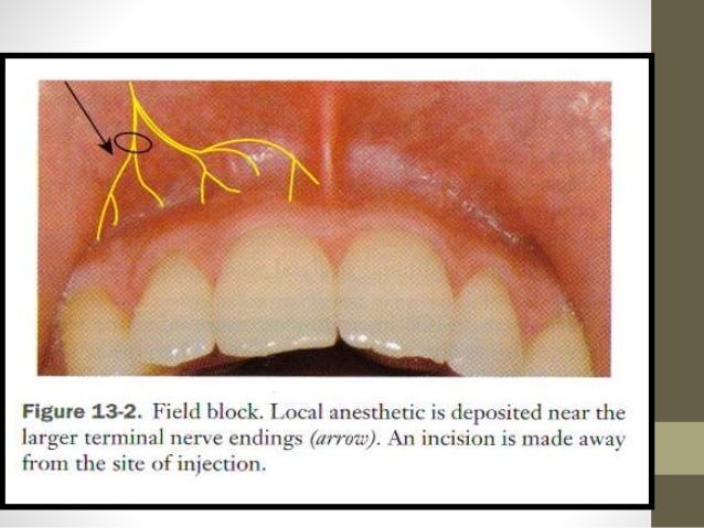 Maxillary anesthesia