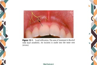 Maxillary anesthesia techniques | PDF