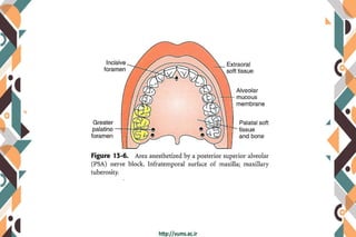 Maxillary anesthesia techniques | PDF