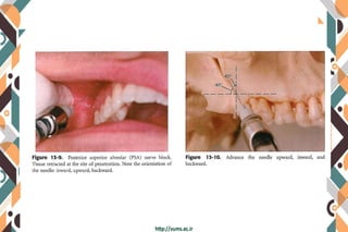 Maxillary anesthesia techniques | PDF