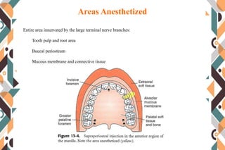 Maxillary anesthesia techniques | PDF