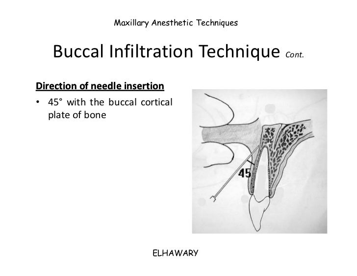 Anesthetic techniques - Maxillary anesthetic techniques