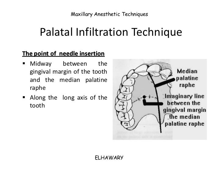 Anesthetic techniques - Maxillary anesthetic techniques