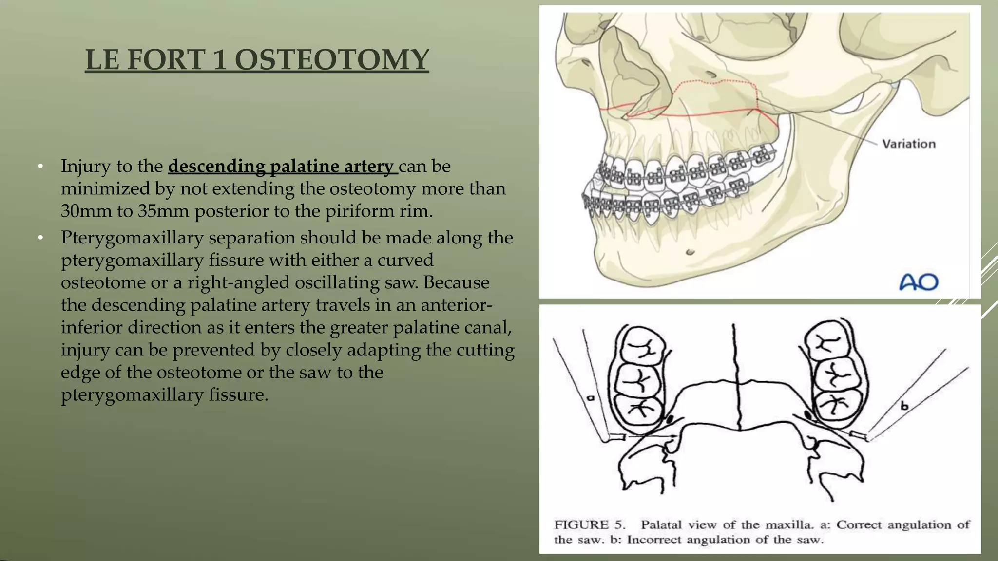 maxillaryarter pptx | PPTX