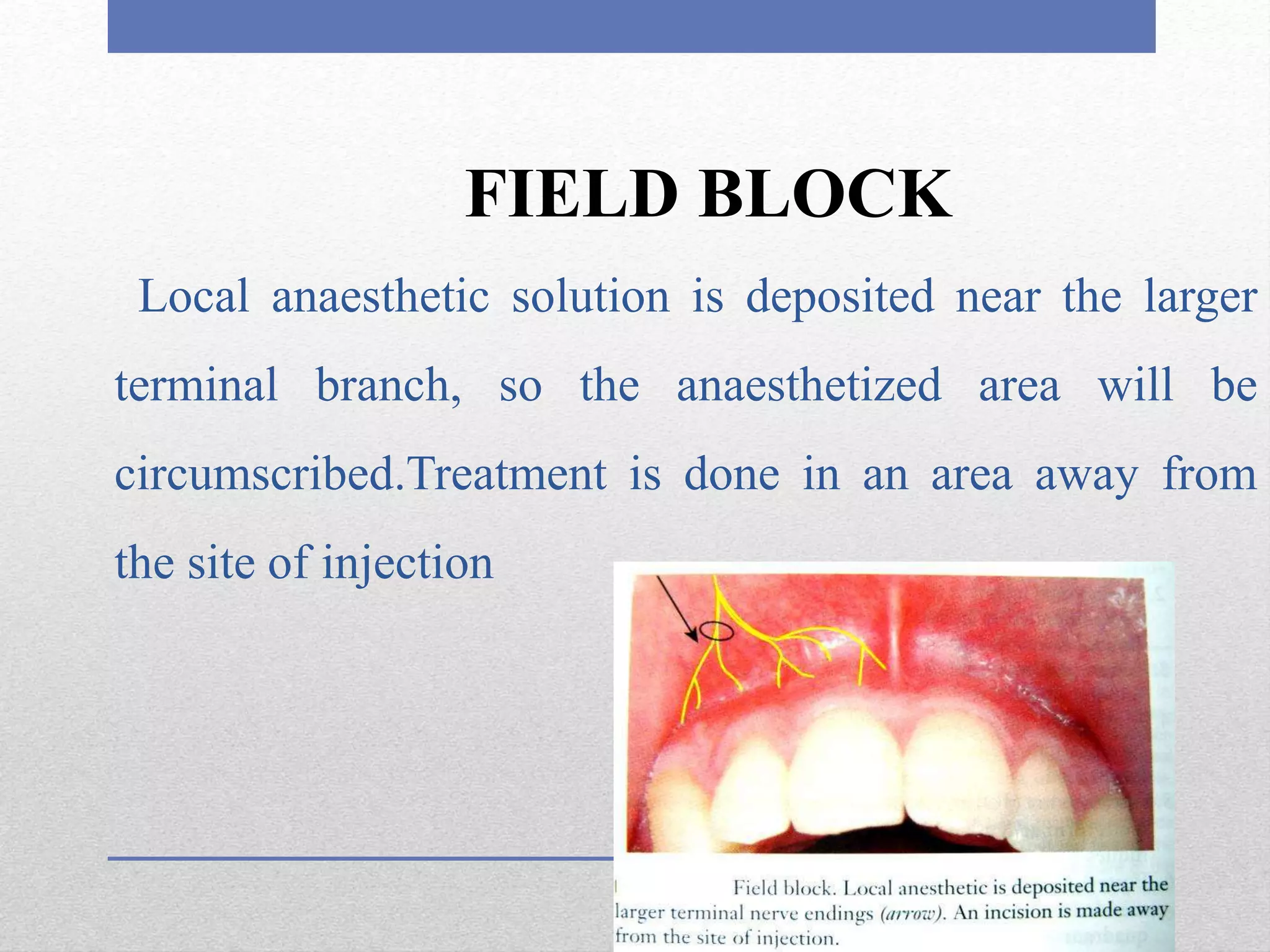 Maxillary blocks | PPTX