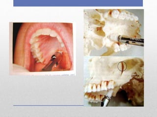 Maxillary blocks | PPTX