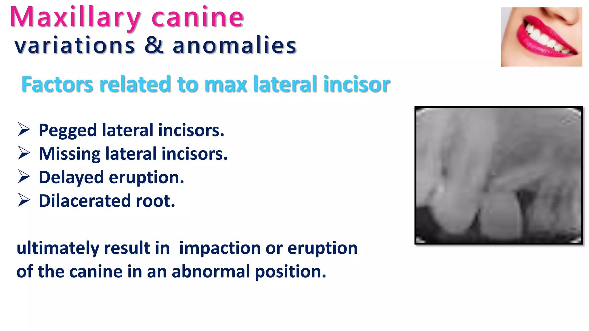 Maxillary canine | PPTX