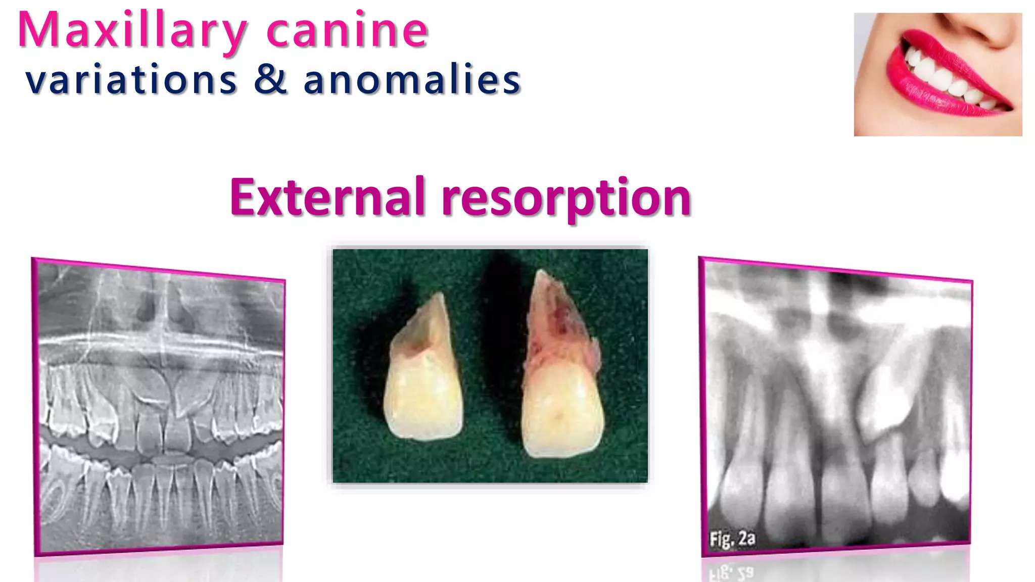 Maxillary canine | PPTX