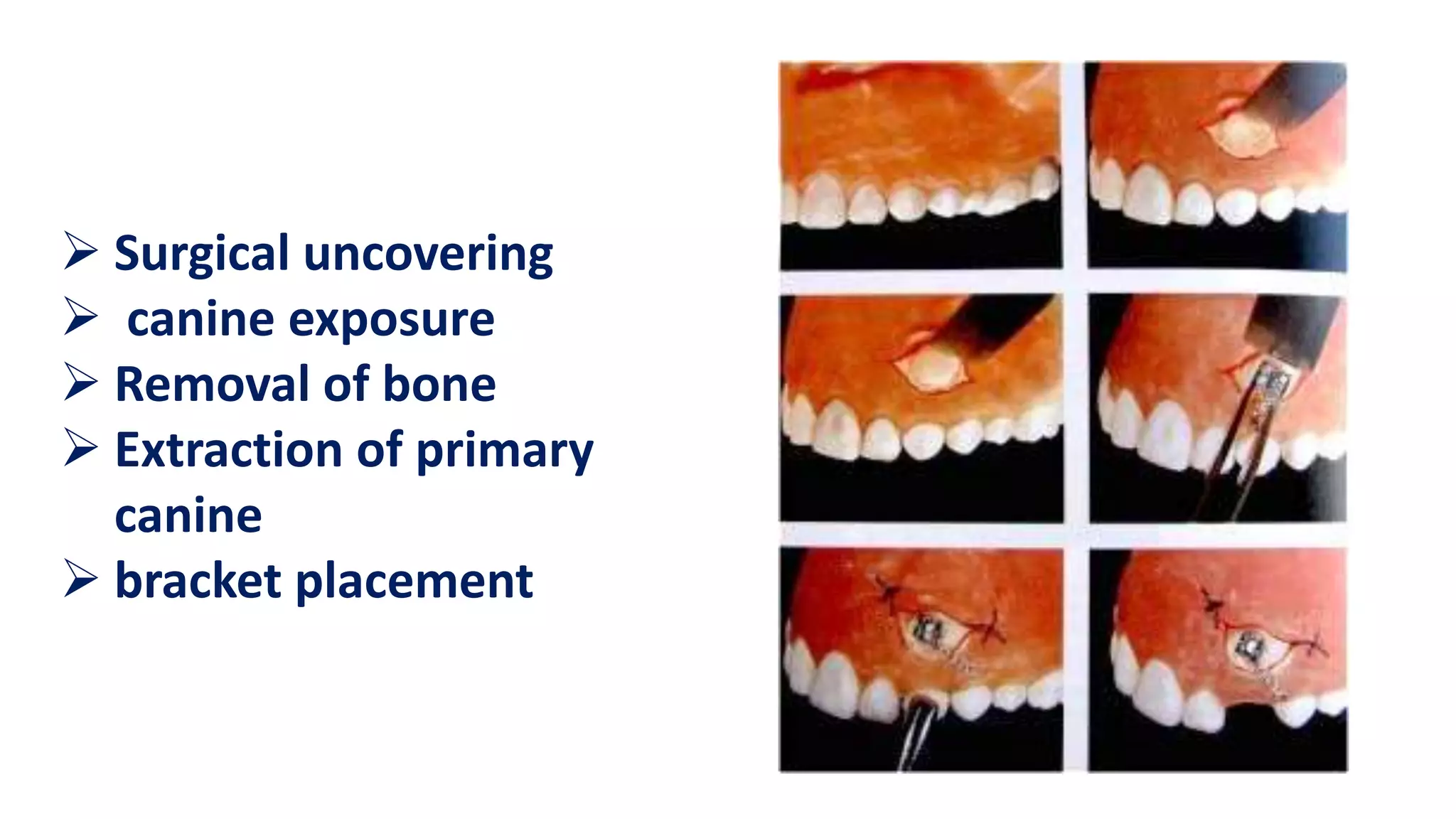 Maxillary canine | PPTX