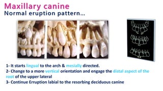 Maxillary canine | PPTX