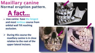Maxillary canine | PPTX