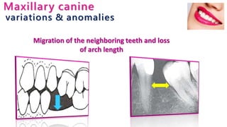 Maxillary canine | PPTX