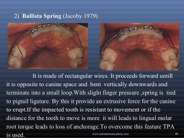 Maxillary canine impaction / oral surgery courses /certified fixed