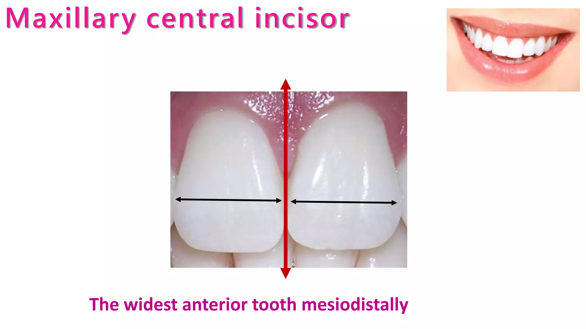 Maxillary central incisor | PPTX