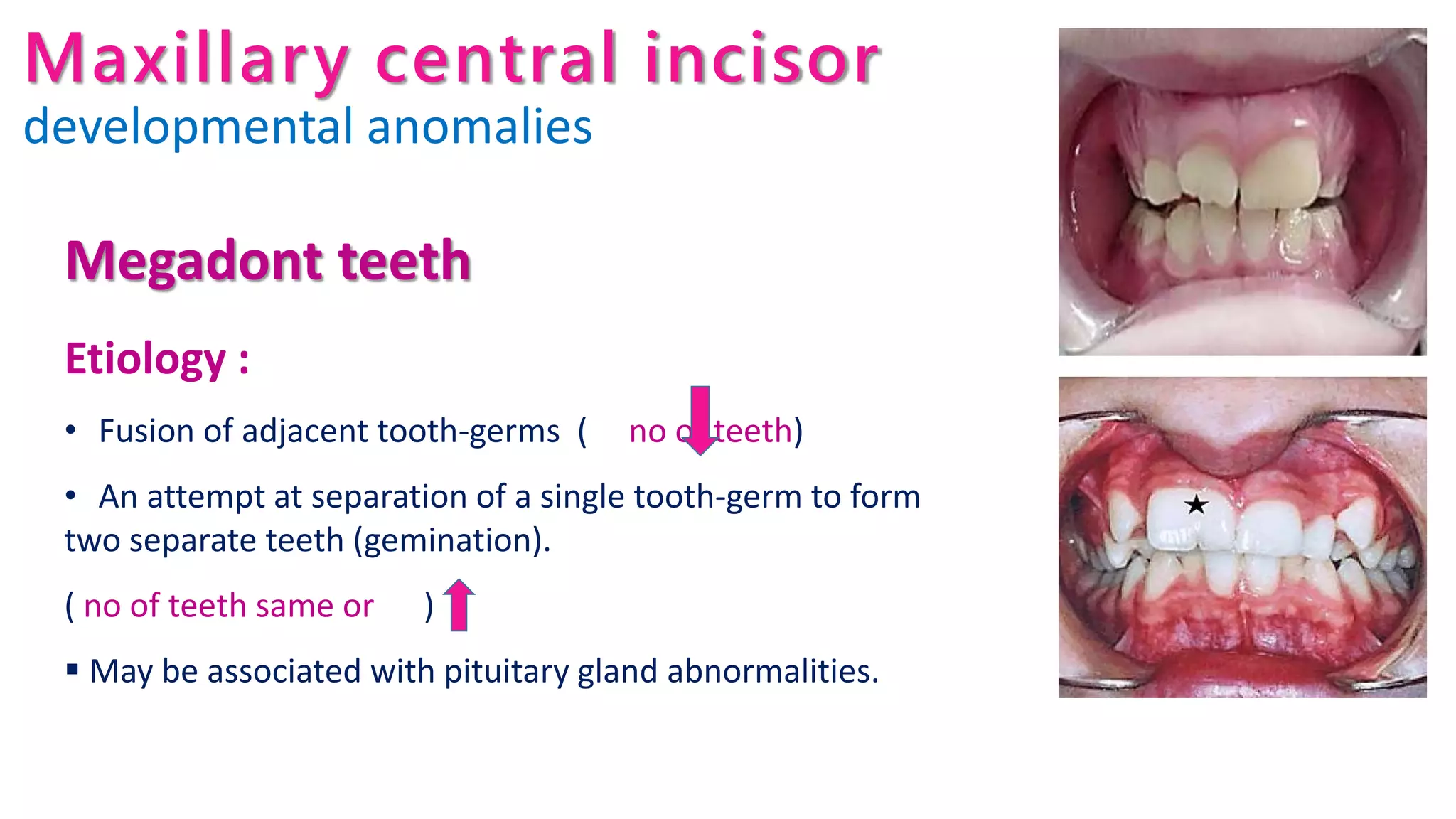 Maxillary central incisor | PPTX