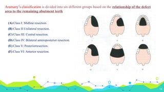 MAXILLARY DEFECTS CLASSIFICATIONS & DIFFERENT PROSTHETIC ...