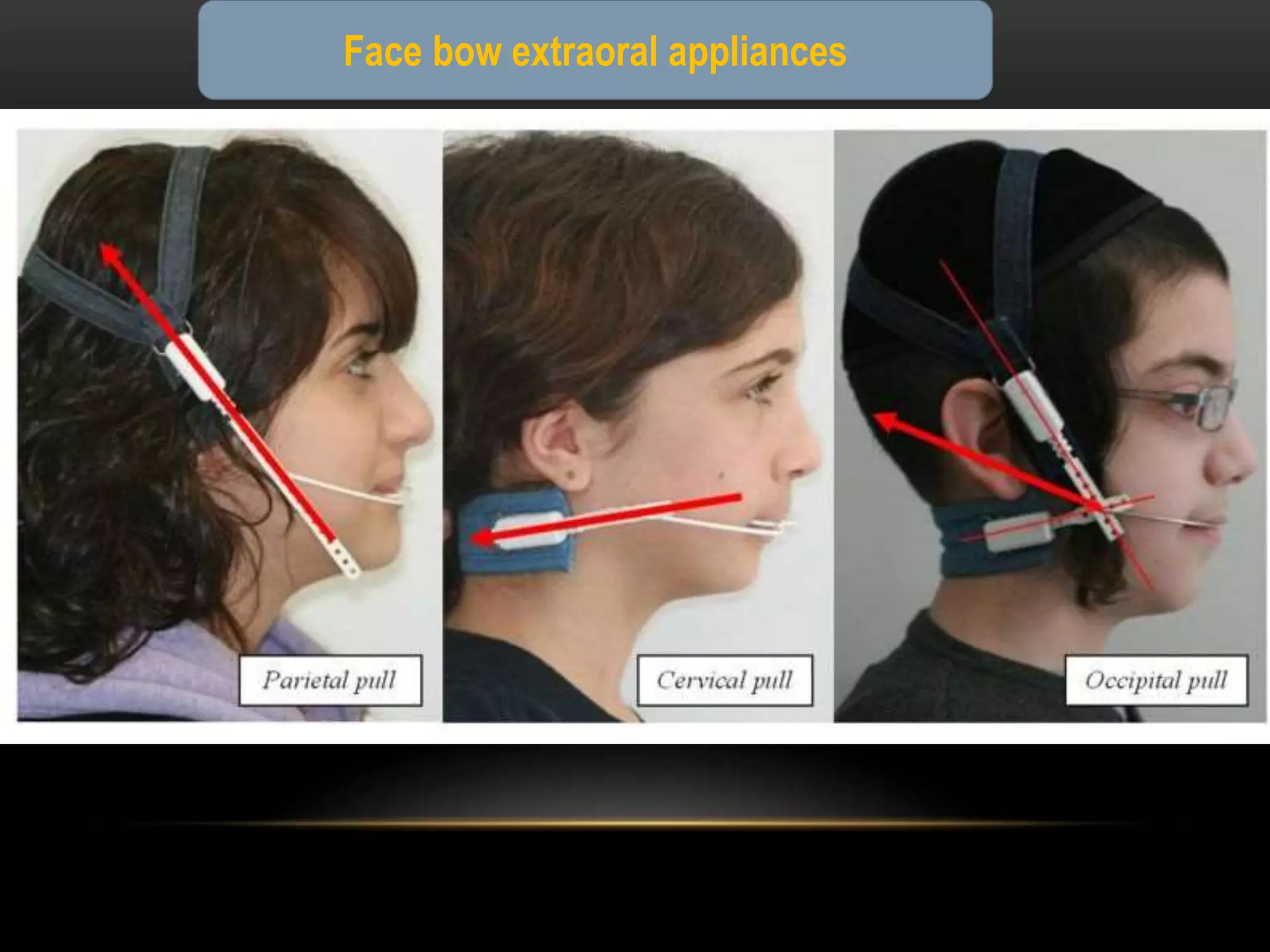 Maxillary distalizers | PPTX