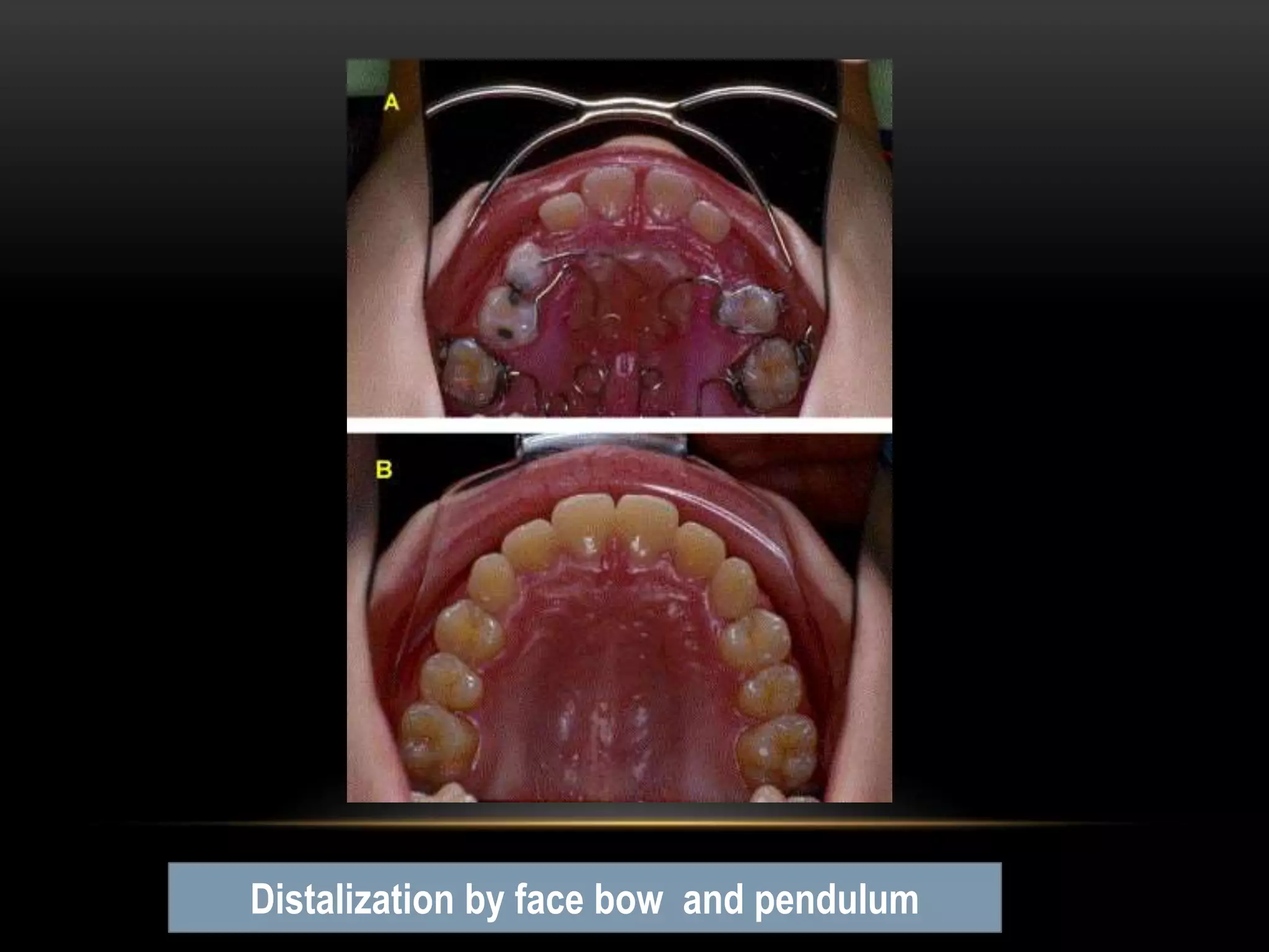 Maxillary distalizers | PPTX