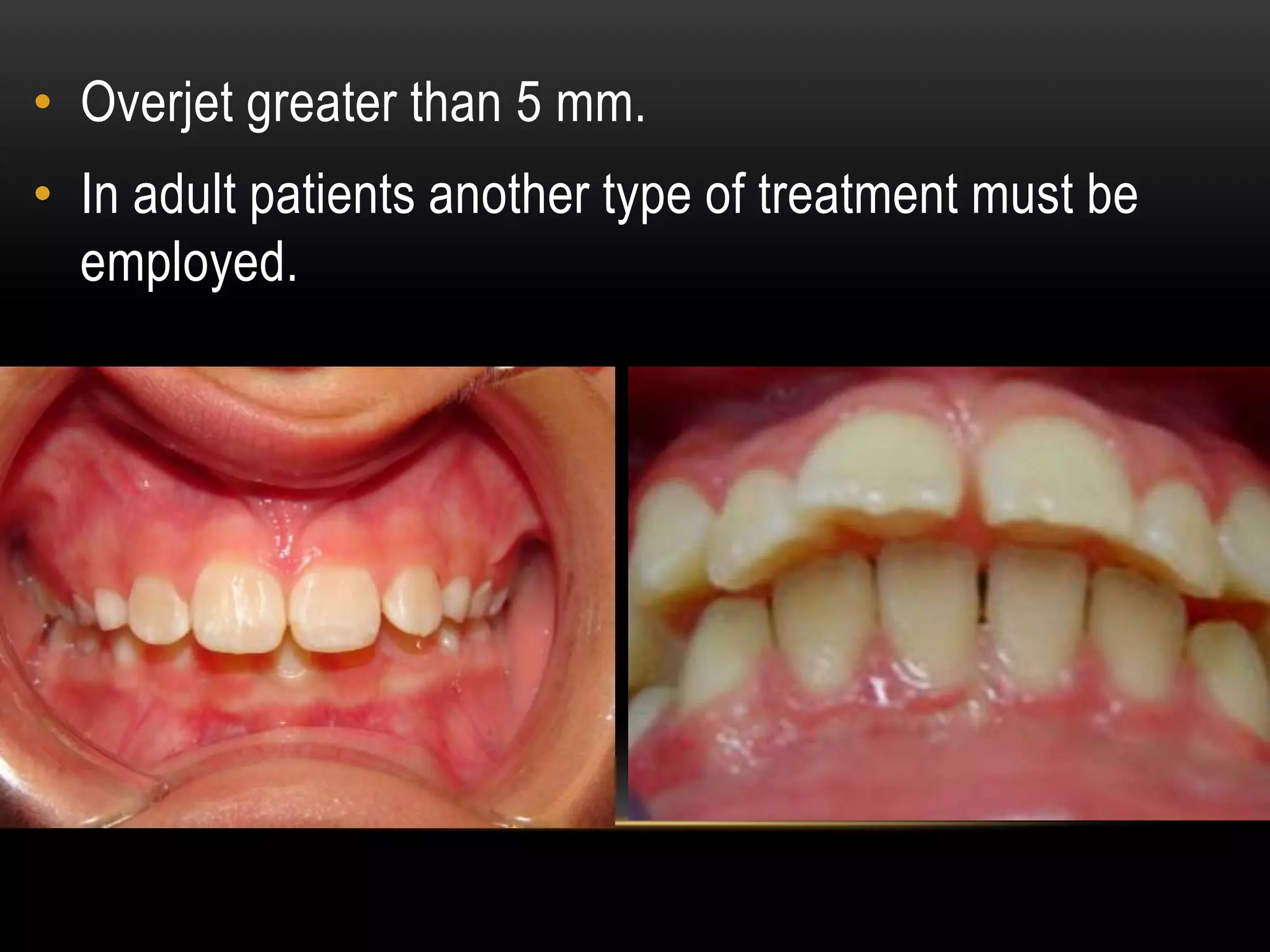 Maxillary distalizers | PPTX