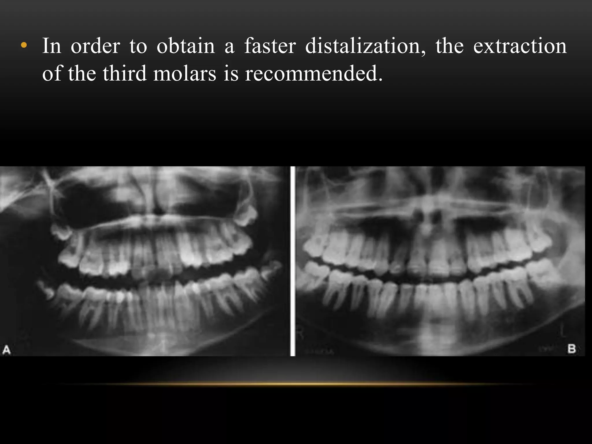 Maxillary distalizers | PPTX