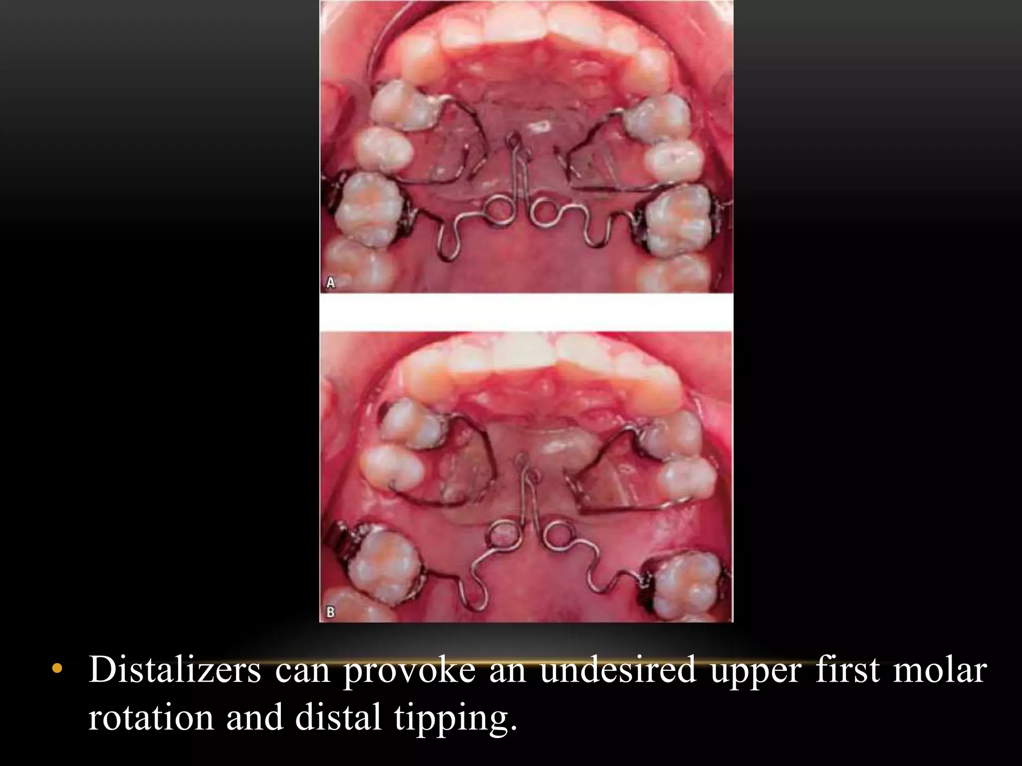 Maxillary distalizers | PPTX