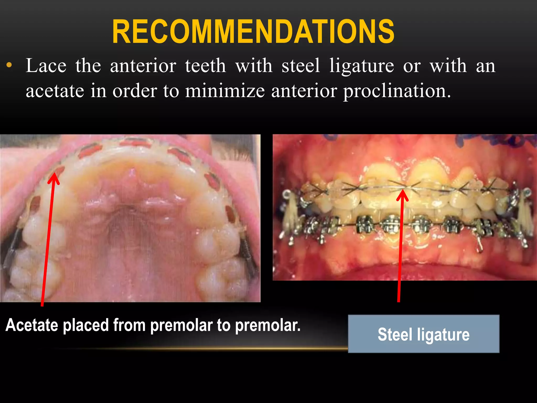 Maxillary distalizers | PPTX