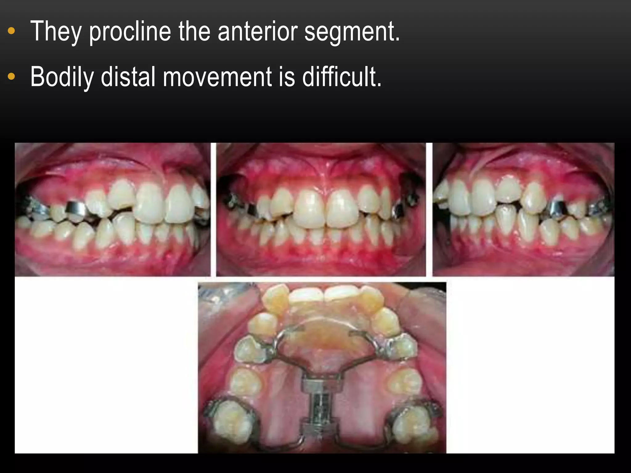 Maxillary distalizers | PPTX