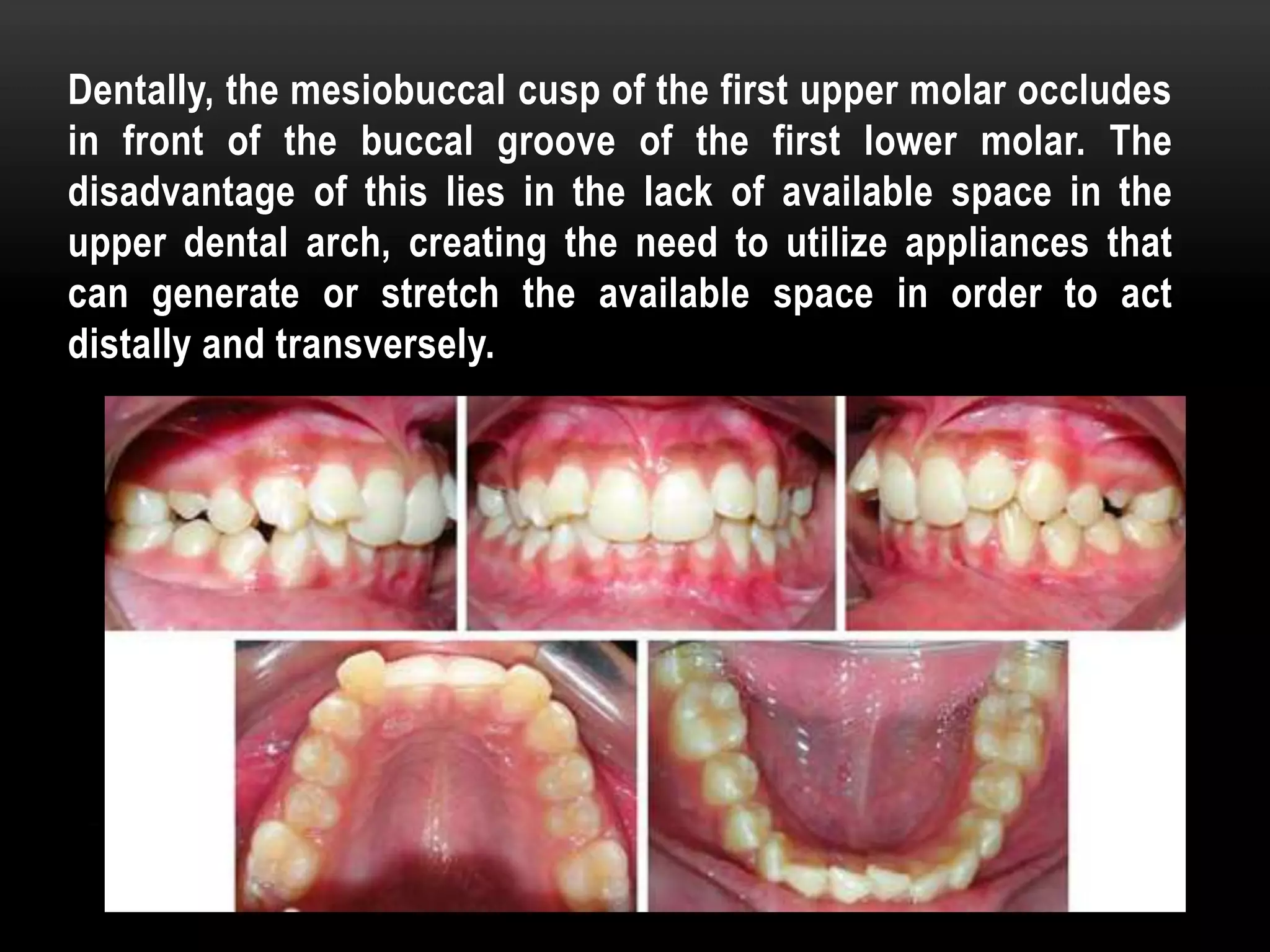 Maxillary distalizers | PPTX