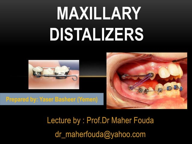 Maxillary distalizers | PPTX