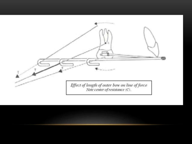 Maxillary distalizers | PPTX