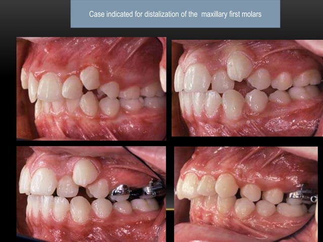 Maxillary distalizers | PPTX