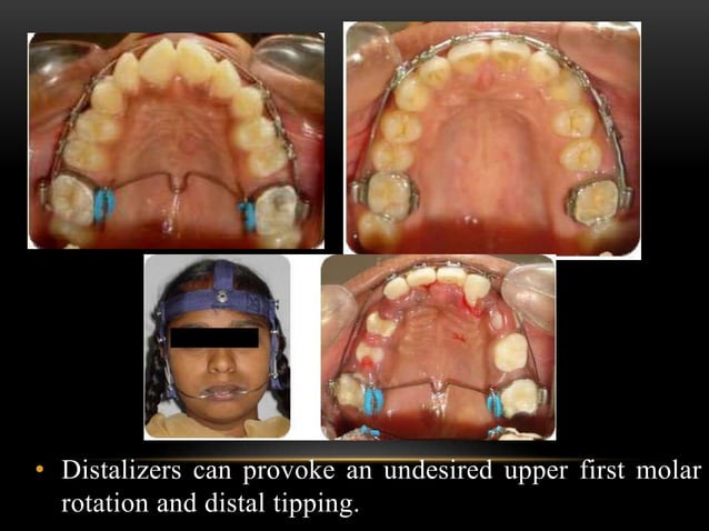 Maxillary distalizers | PPTX