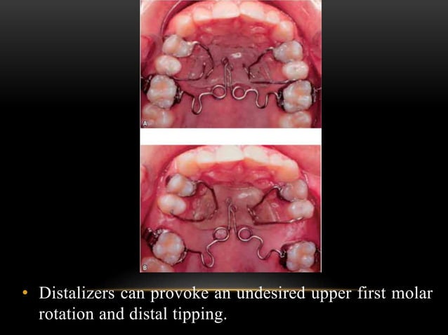 Maxillary distalizers | PPTX