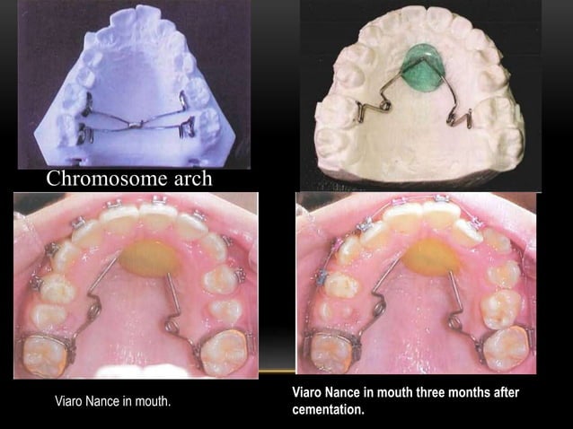 Maxillary distalizers | PPTX