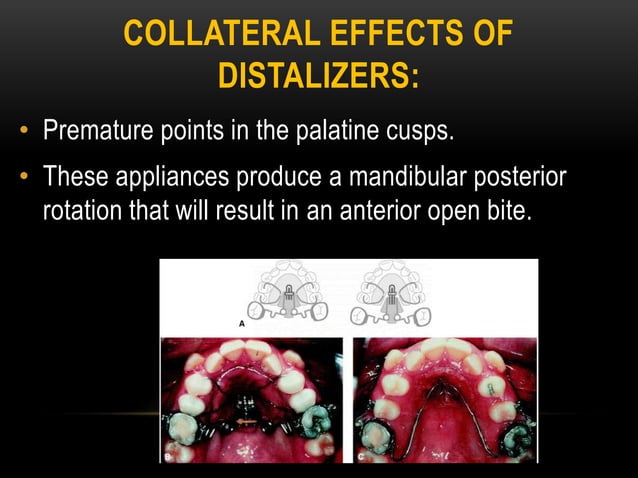 Maxillary distalizers | PPTX