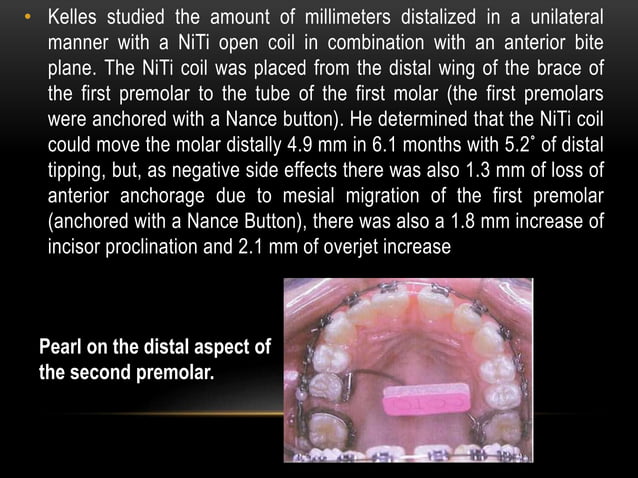 Maxillary distalizers | PPTX
