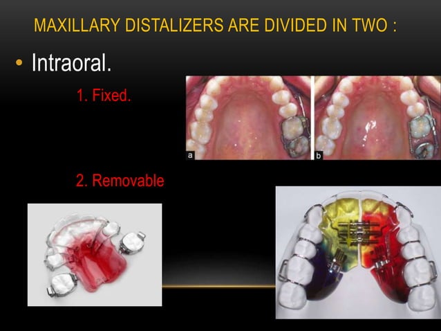 Maxillary distalizers | PPTX
