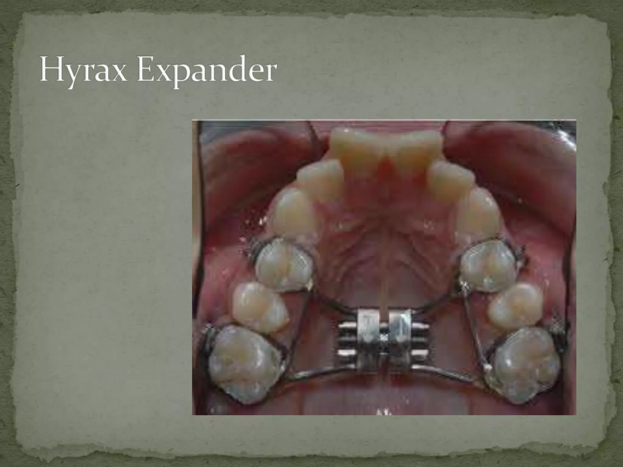 Maxillary expansion | PPTX