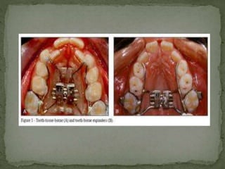Maxillary expansion | PPTX