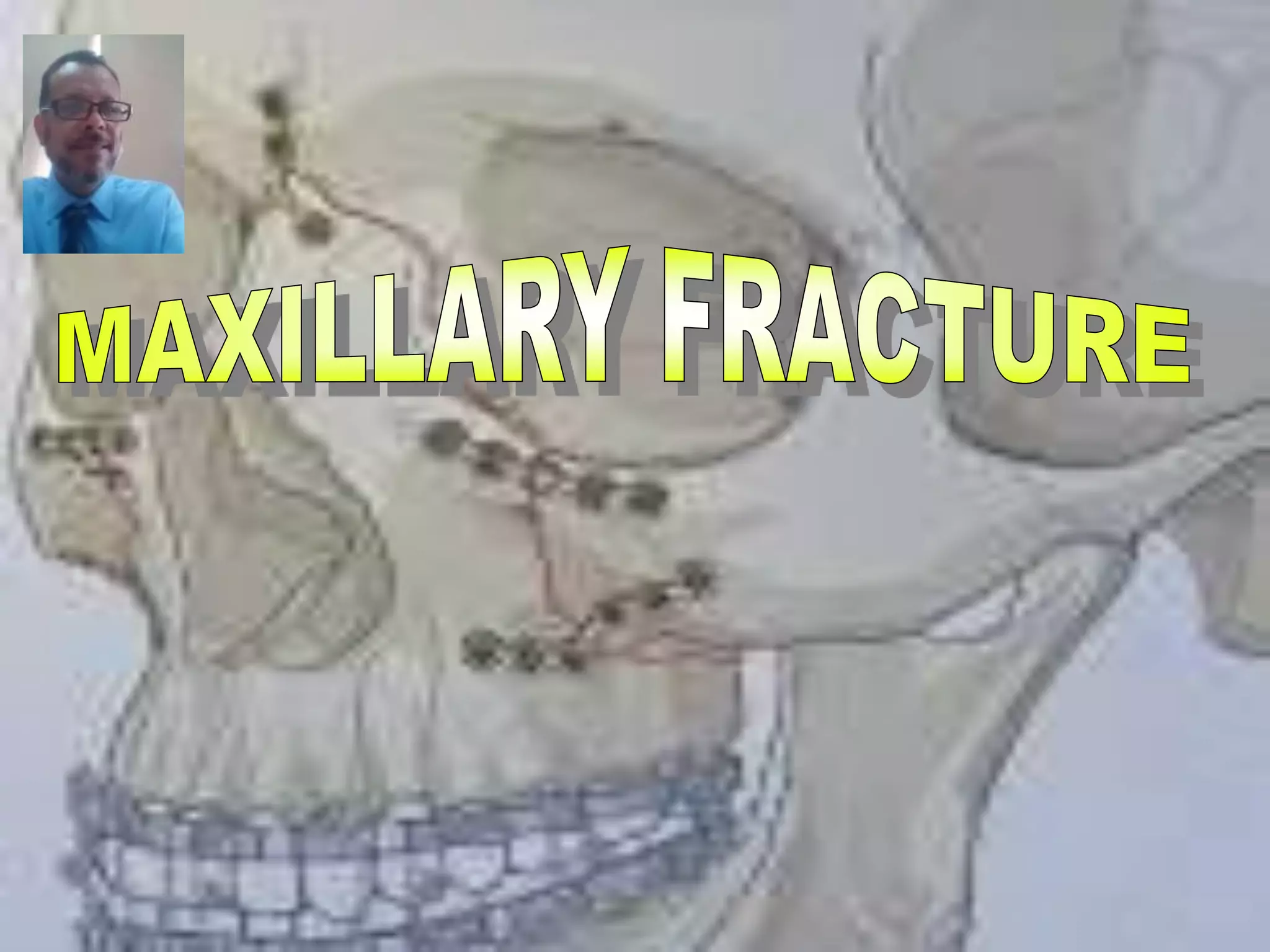 Mid face fracture-Maxillary fracture | PPT