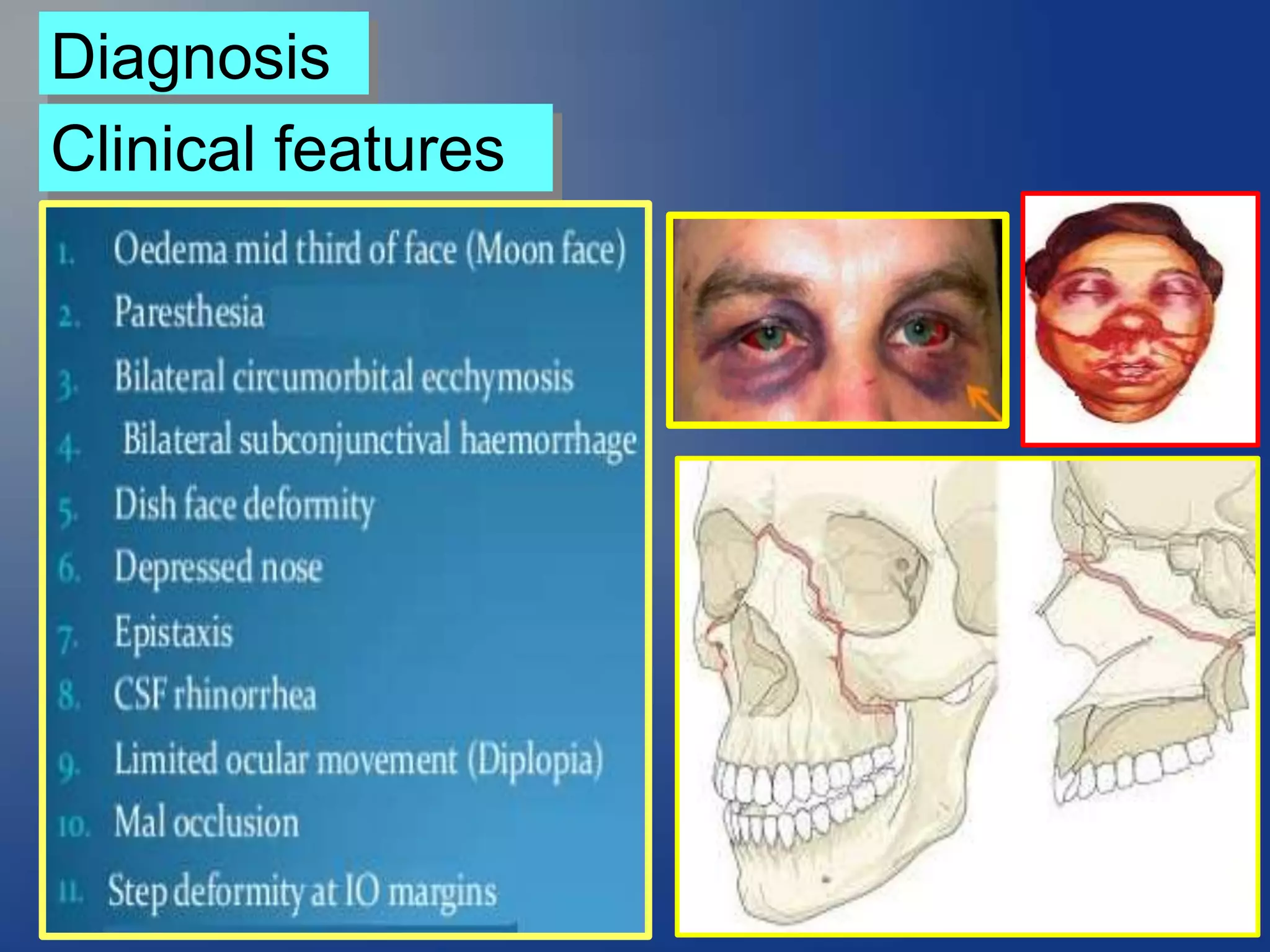 Mid face fracture-Maxillary fracture | PPT