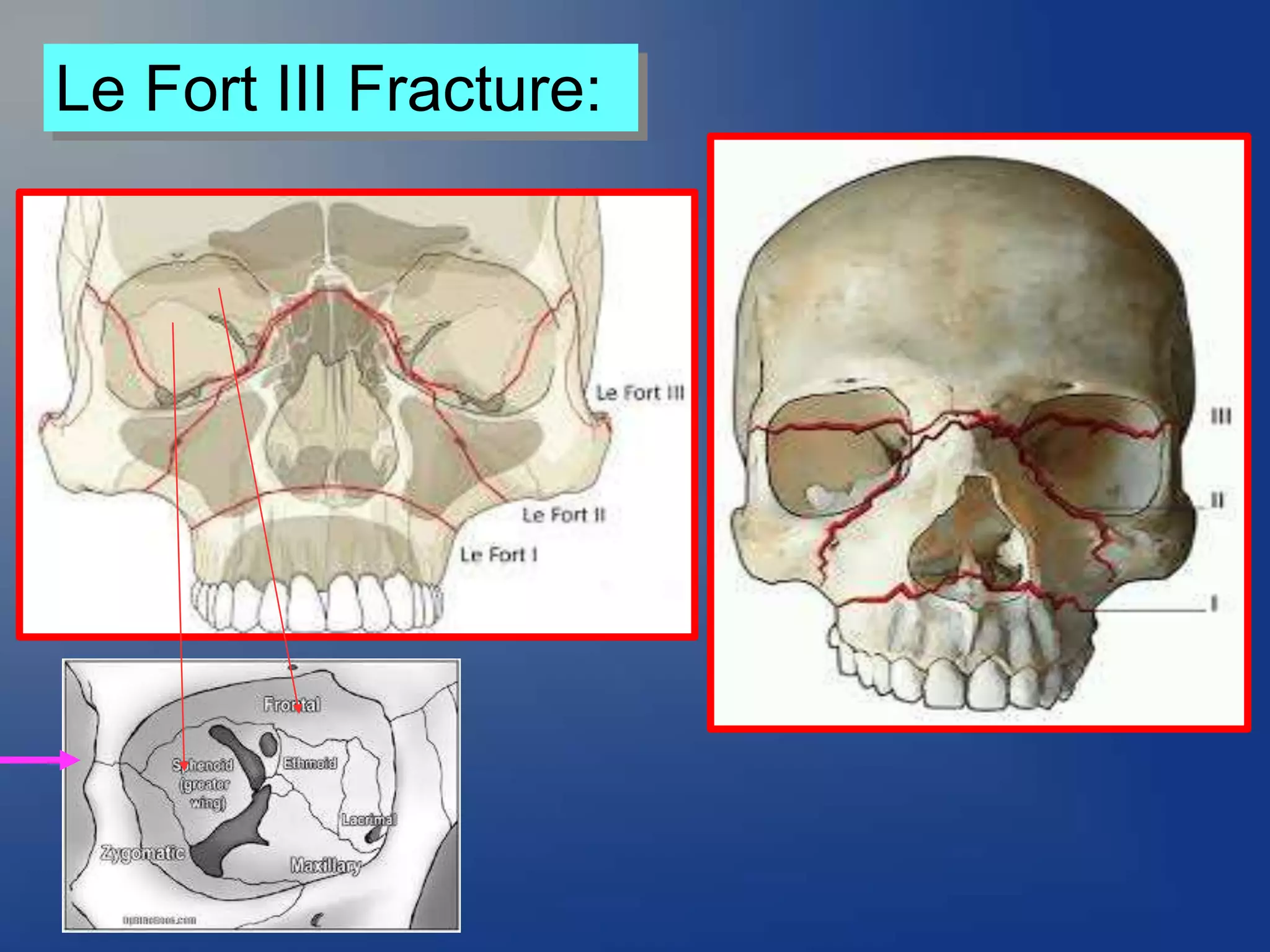 Mid face fracture-Maxillary fracture | PPT