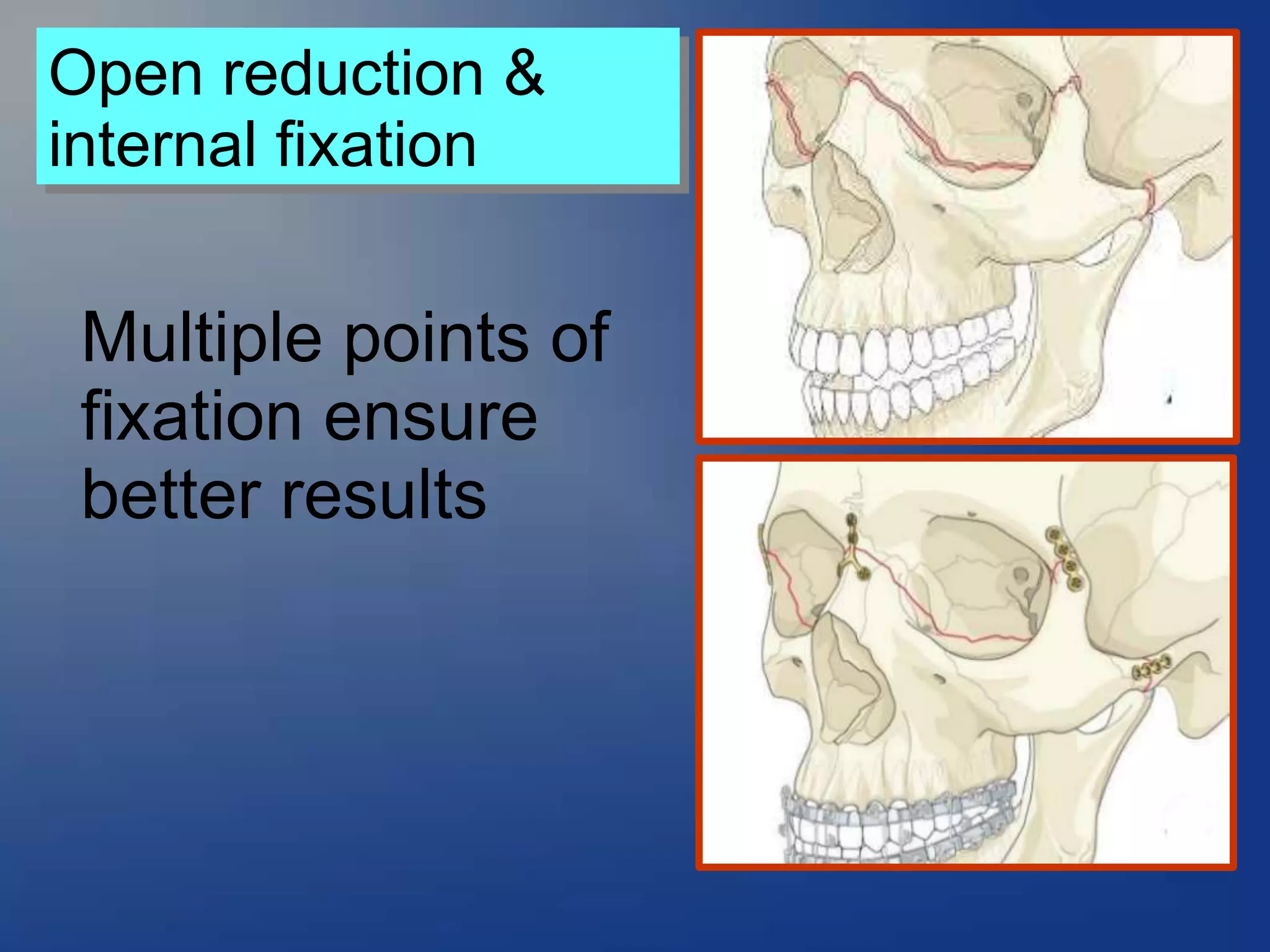 Mid face fracture-Maxillary fracture | PPT