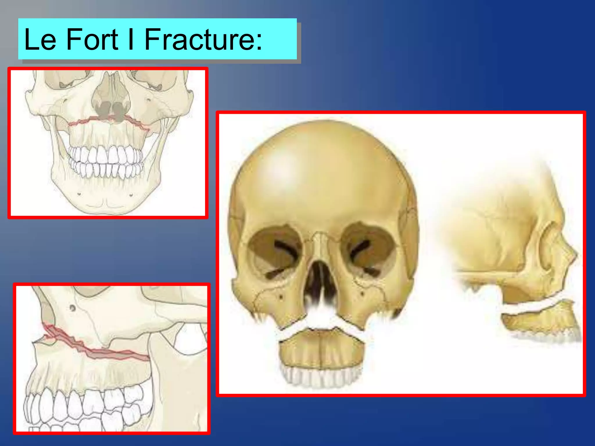 Mid face fracture-Maxillary fracture | PPT