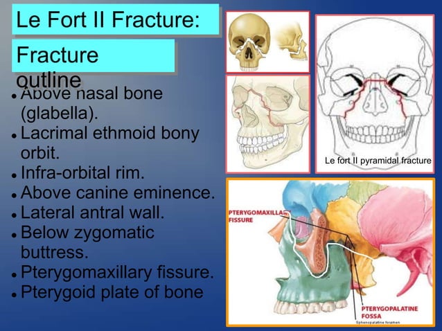 Mid face fracture-Maxillary fracture | PPT